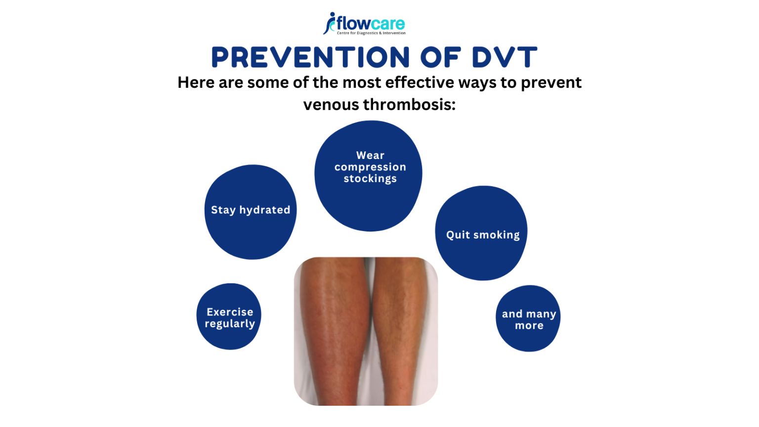 Prevention of DVT | DVT Precautions | Deep Vein Thrombosis Treatment