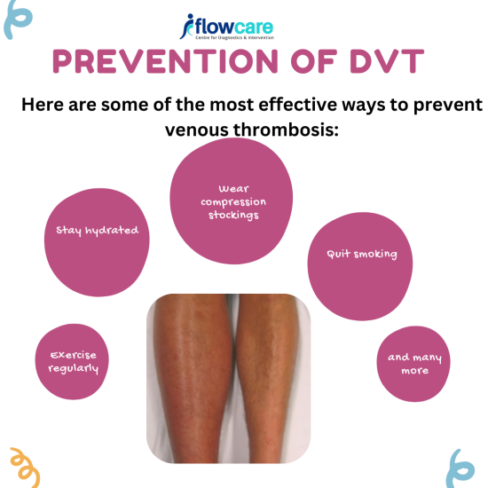 Prevention of DVT