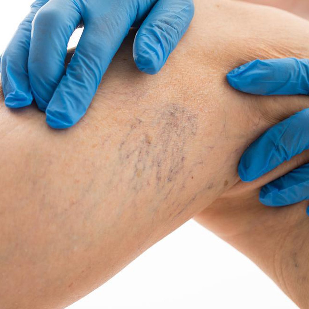 Dark Blue Veins | Causes, Symptoms & Treatment