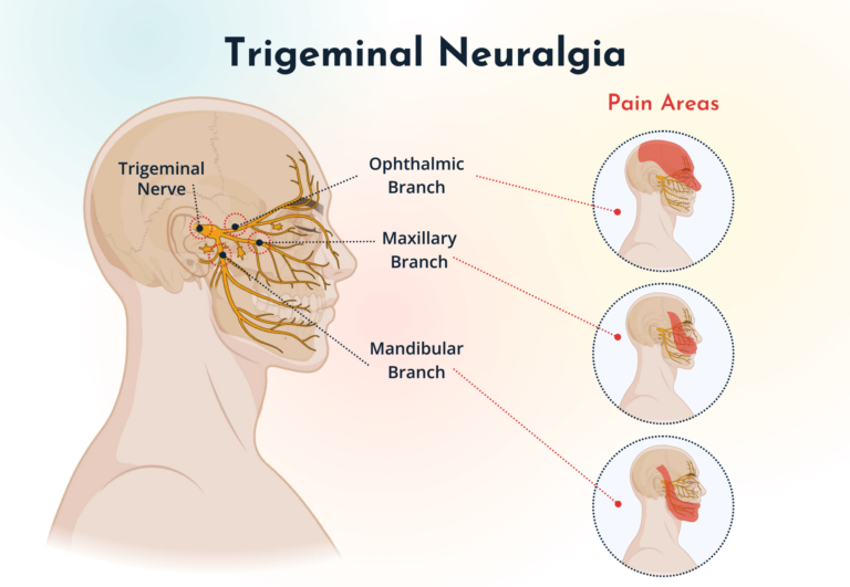 Living with Trigeminal Neuralgia: Coping Mechanisms and Support ...