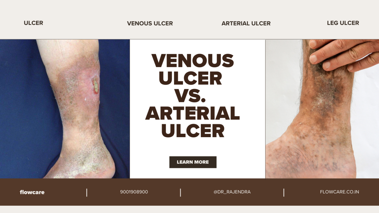 Venous Leg Ulcer vs. Arterial Ulcer: Differences, Symptoms, and ...